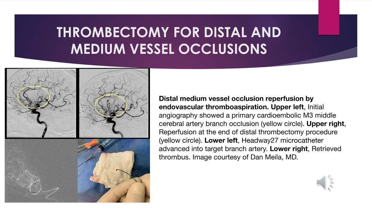 Thrombectomy for Distal and Medium Vessel Occlusions - Neurology Clinic ...